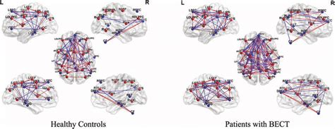 The Functional Connectivity In Patients Bects Right And Healthy Download Scientific Diagram