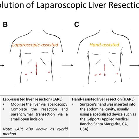 Evolution Of Laparoscopic Liver Resection Exemplary Illustration Of Download Scientific