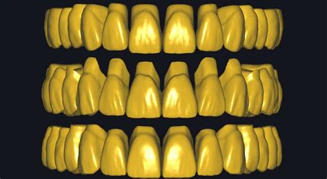 Exocad 3d Library Enhance Your Digital Dentistry Practice