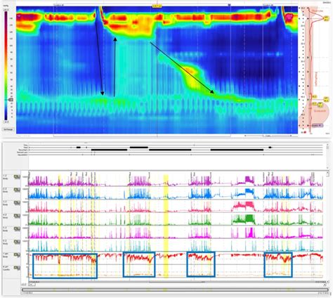 High Resolution Manometry Iom And Pathological Reflux Case4