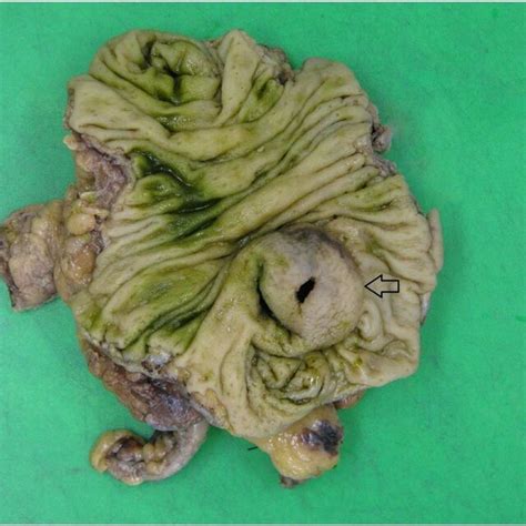 Macroscopic View Of Specimen Post Fixation With Duplication Cyst