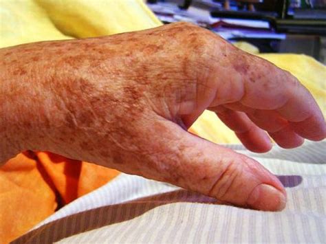 Коричневые пятна на коже или нарушение пигментации кожи