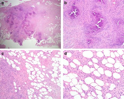 Calcifying Aponeurotic Fibroma A Showing Foci Of Calcification And Download Scientific