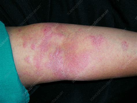 Atopic Dermatitis Stock Image C056 7942 Science Photo Library