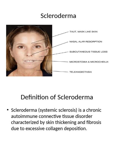 Scleroderma Presentation Pdf Medical Specialties Human Diseases And Disorders