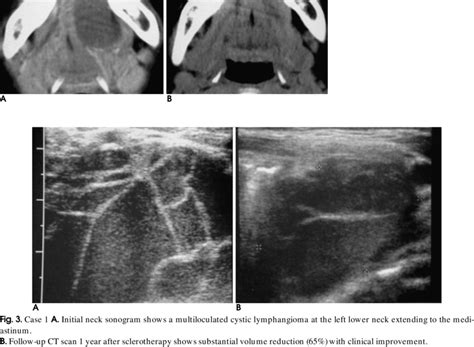 Case 6 A Initial Contrast Enhanced Ct Scan Shows A Cystic Lesion At