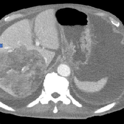 Enhanced Computed Tomography Revealing Hepatic Metastases Rupture With Download Scientific