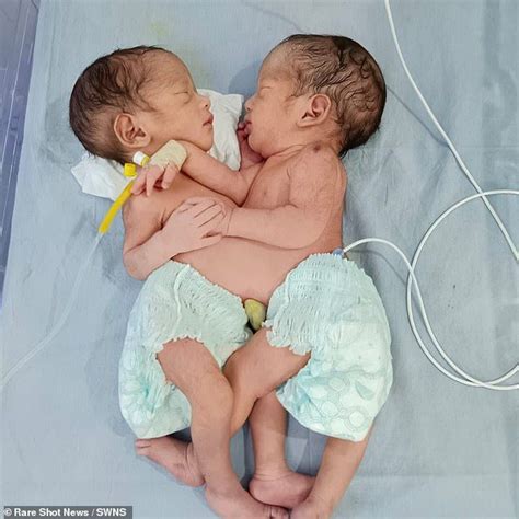 22 Year Old Indian Woman Gives Birth To Conjoined Twins Conjoined From
