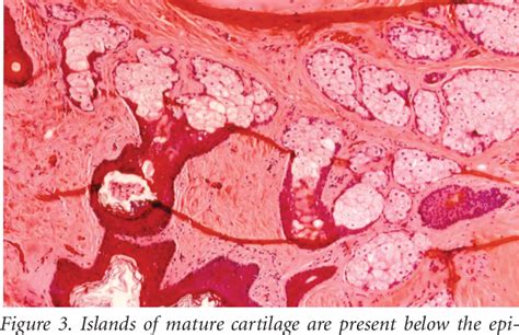 Figure 2 From Dermoid Cyst Of The Parotid Gland Semantic Scholar