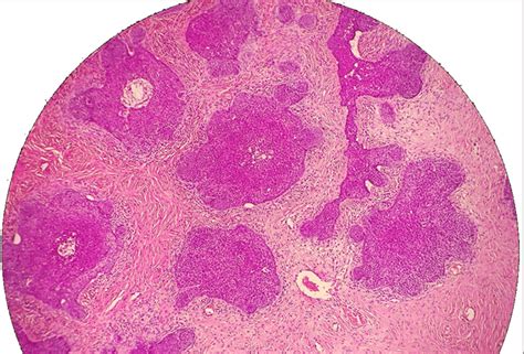 Multiple Clusters Of Polygonal Basaloid Cells Download Scientific Diagram