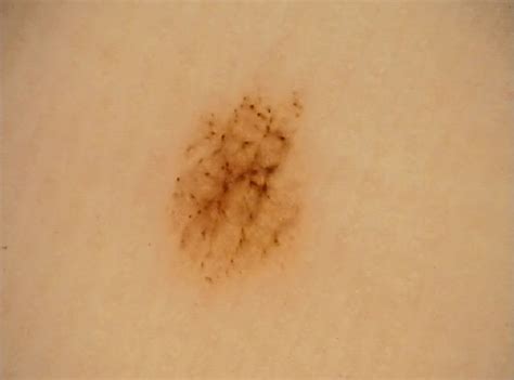 Dermoscopic Patterns Of 158 Acral Melanocytic Nevi In A Latin American Population Actas Dermo Dermoscopic Patterns Of 158 Acral Melanocytic Nevi In A Latin American Population Actas Dermo