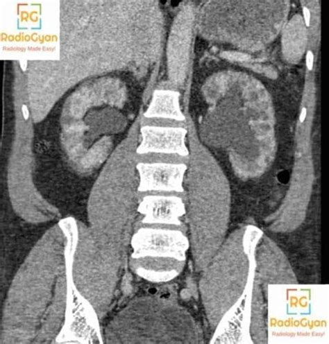 Subependymal Heterotopia Radiology Case Radiogyan Radiogyan