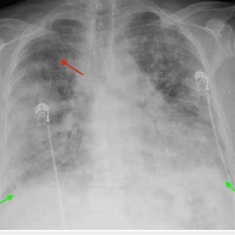 Chest X Ray Showing Ground Glass Opacity Diffuse Patchy Airspace