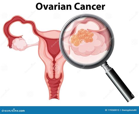Ovarian Cancer Ovarian Carcinoma Germ Cell Tumor Sex Cord Stromal