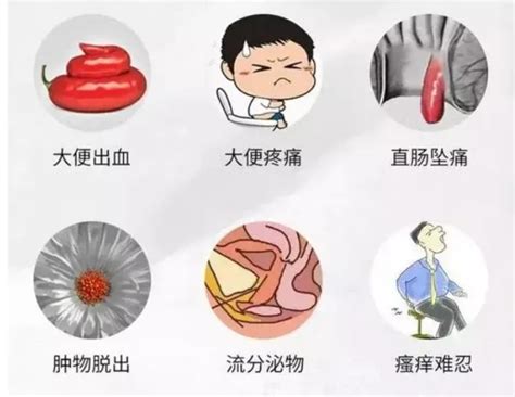 痔疮肉球脱出疼痛难忍怎么办？日常做到这几点！ 哔哩哔哩