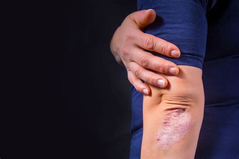 Psoriasis Elbow