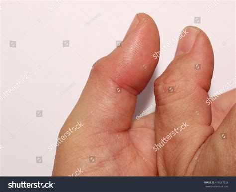 Swollen Thumb Joint Gout Swollen Joints What Causes Joint Swelling