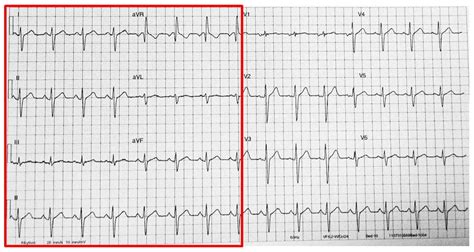 Ekg Axis