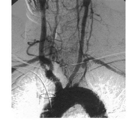 Aortic Arch Arteriogram Showing Complete Occlusion Of The Left Download Scientific Diagram
