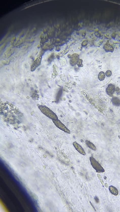 Sputum Sample From My Daughter Some Look Like Turds Others Like Eggs The Majority Look Fungal