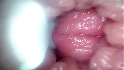 Endoscope Videos Xvideos Com