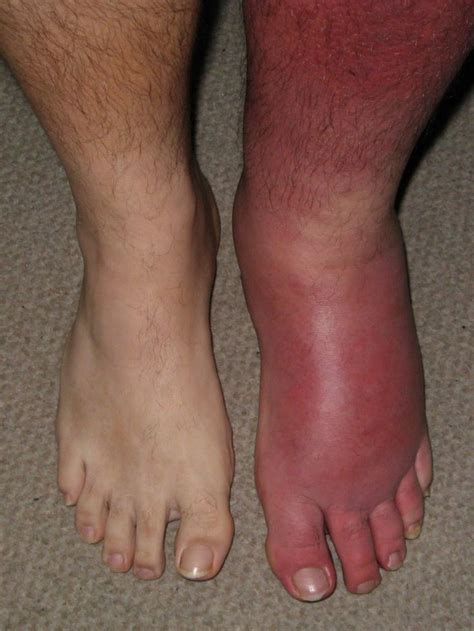 9 Best Cellulitis Leg Images On Pinterest Cellulitis Infection Infected Cut And Cellulitis