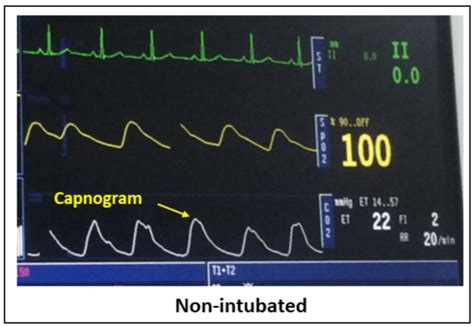 Capnography In The Nonintubated Patient Virtual Library Leonard Otieno Rn 🇰🇪