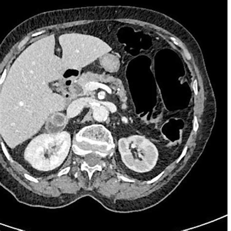 A Abdomen Ct Scan Demonstrating Type Iii Hydatid Cyst Lesion In The