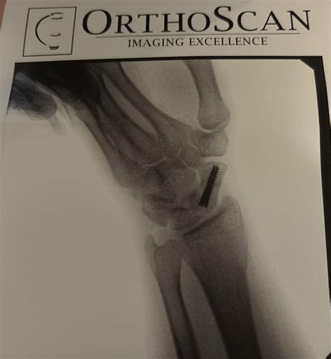 Got A Screw For My Scaphoid Fracture Today Rradiology