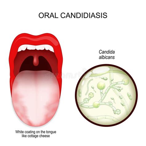 Oral Candidiasis Oral Thrush Yeast Infection Stock Vector Illustration Of Health Human