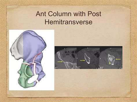 Acetabular Fracture Radiology Xrays Ct Scan And 3d Printing Pptx