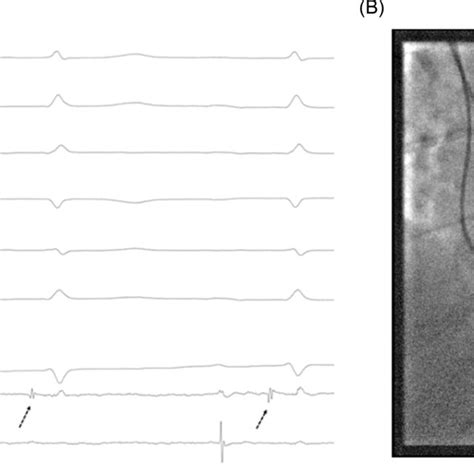 Intracardiac Electrogram Recordings A From The Radiofrequency