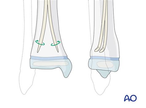 Elastic Nailing For Simple Transverse Tibial Fracture