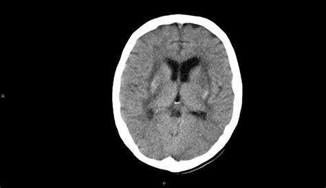 Methanol Intoxication Pacs