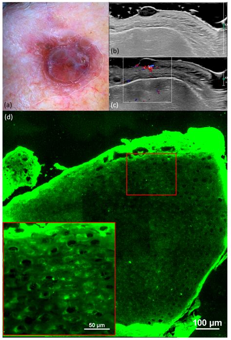 Nodular Adenoid Bcc Dermoscopy Shows Arborized Vessels Blue Grey Download Scientific Diagram