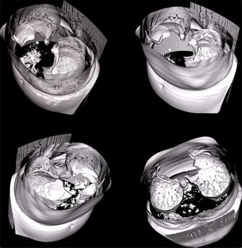Results Of The 380 Slice X Ray Scan Segmentationbone Structure Download Scientific Diagram