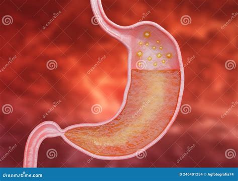 Gastritis Is An Inflammation Of The Inner Lining Of The Stomach That