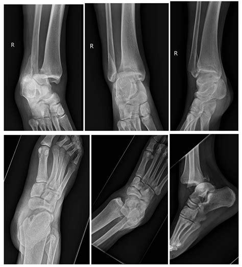 Swing And A Miss Ankle Fracture Dislocations In The Ed — Kwak Talk