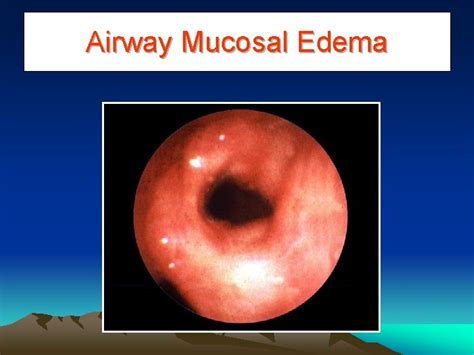 An Overview Of Bronchial Asthma By Prof Nadeem