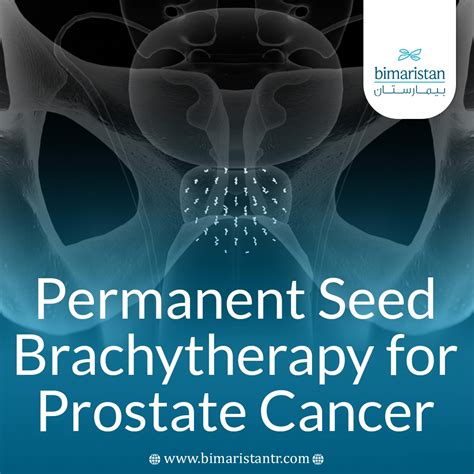 Permanent Seed Brachytherapy For Prostate Cancer Bimaristan