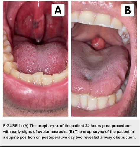 Figure 1 From Uvular Necrosis Day To Day Progression Of A Rare Postoperative Complication