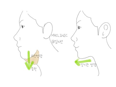 이중턱을 리프팅 방법중 실루엣 소프트가 처진 턱부위를 당겨주는 데는 가장 뛰어난 시술이라고 생각하는 이유 Mh클리닉 네이버 블로그