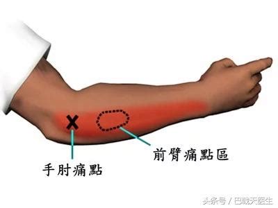 肘關節痛家中有這兩味藥不用怕 每日頭條