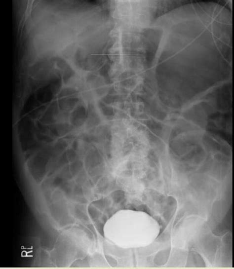 Paralytic Adynamic Ileus Gastrointestinal Medbullets Step 2 3