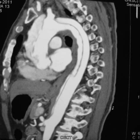 E Ct Thorax Showing Type A Dissection With Intimal Flap False Lumen In
