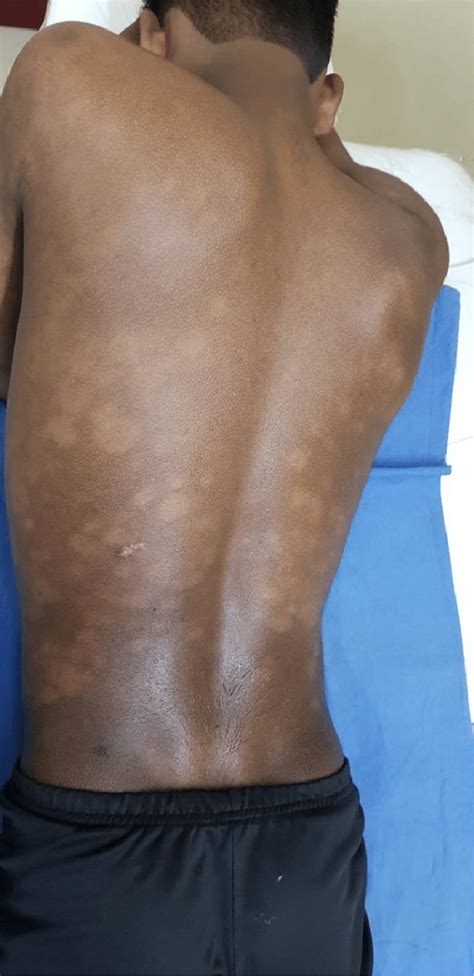Back Of Trunk Showing Multiple Hypopigmented Macules Download