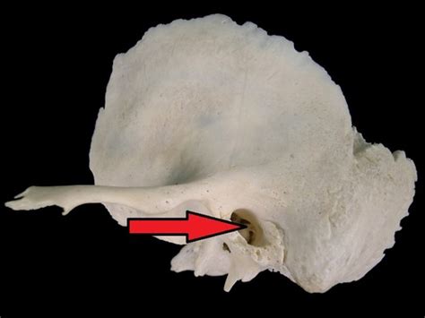 Temporal Bone Flashcards Quizlet