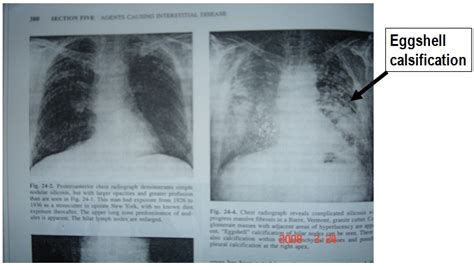Public Health Silicosis
