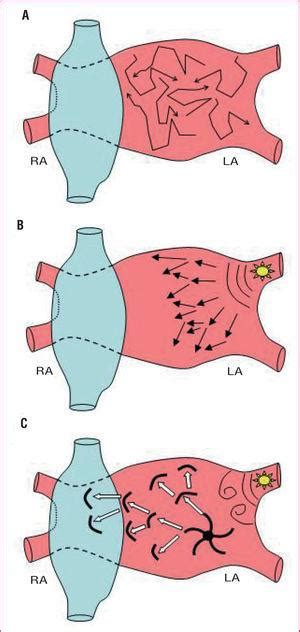 The Atrial Fibrillation Substrate Pulmonary Veins Posterior Wall Or Both Revista Española De