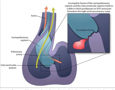Figure 1 From Cross Sectional Imaging Of Sinus Of Valsalva Aneurysms